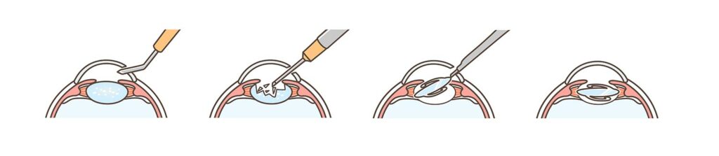 Cataract Surgery - Heathrow Surgery Center